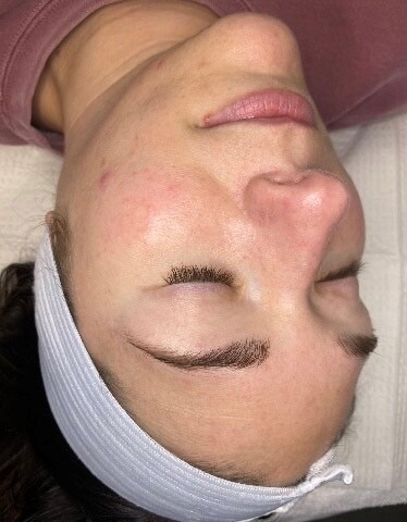 Full ZO Protocol, microneedling, and HydraFacial