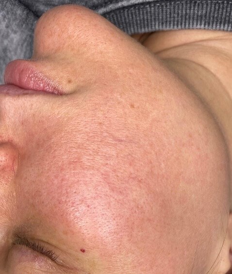 Full ZO Protocol, microneedling, and HydraFacial