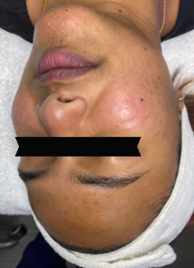 Full ZO Protocol, microneedling, and HydraFacial